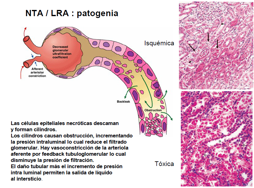 Necrosis tubular aguda; Nefrosis de la Nefrona Distal