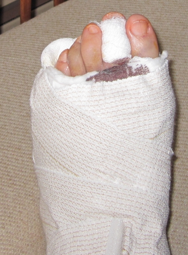 Voyage of S/V Sea Biscuit: Bunion update