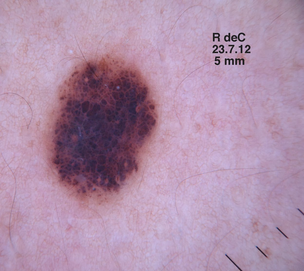 VIRTUAL GRAND ROUNDS IN DERMATOLOGY 2.0: Changing Nevus