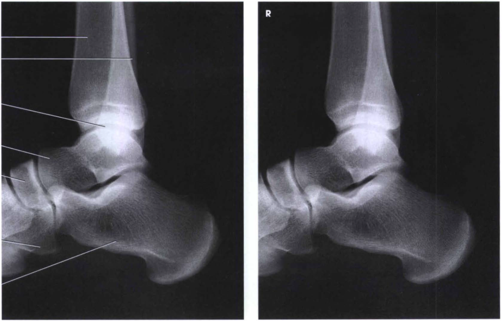TEKNIK RADIOGRAFI ANKLE JOINT - Radiografer
