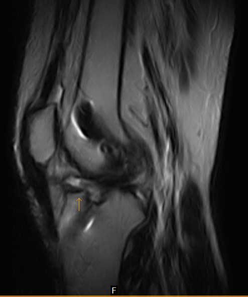 Post ACL Repair-MRI - Sumer's Radiology Blog