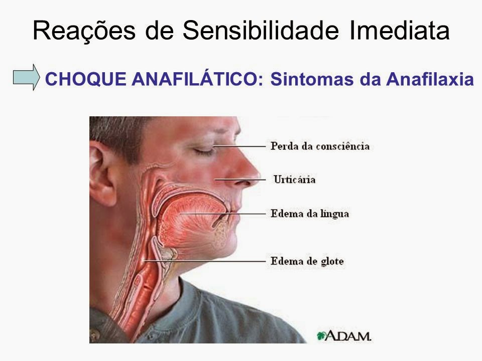 Consciente e Inconsciente: CHOQUE ANAFILATICO.