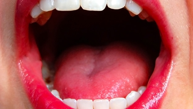 Tumor de la lengua Síntomas y Tratamientos | Salud y Cuidados