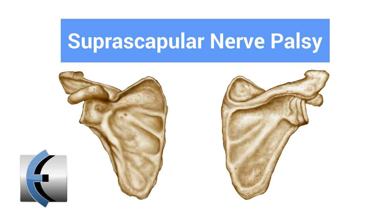 Betty Roche: Suprascapular Nerve Palsy