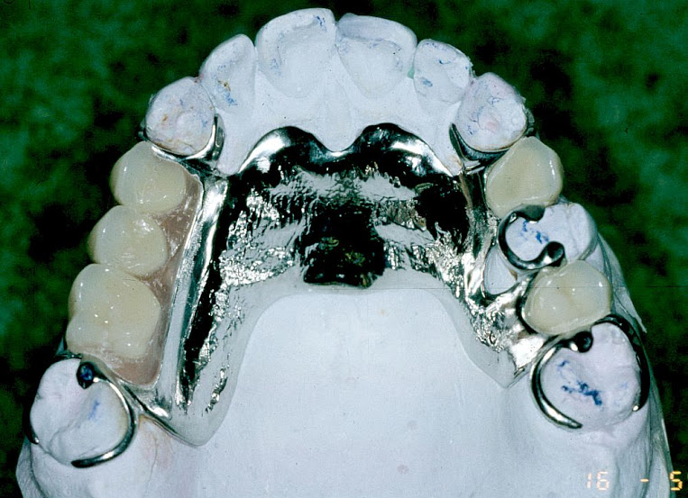 PRÓTESE DENTAL: Grampos utilizados em PPR