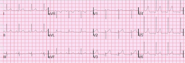 Repolarization Ecg