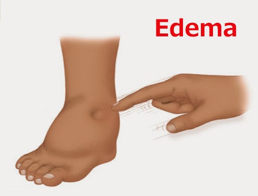 Edema (Water Retention) – Symptoms, Home and Herbal Remedies - Dr ...