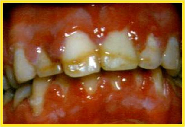 Dentistry lectures for MFDS/MJDF/NBDE/ORE: Images and Description Of ...