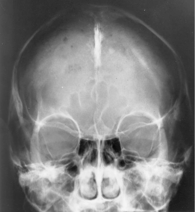 Estomatologia Online: Síndrome de Gorlin-Goltz