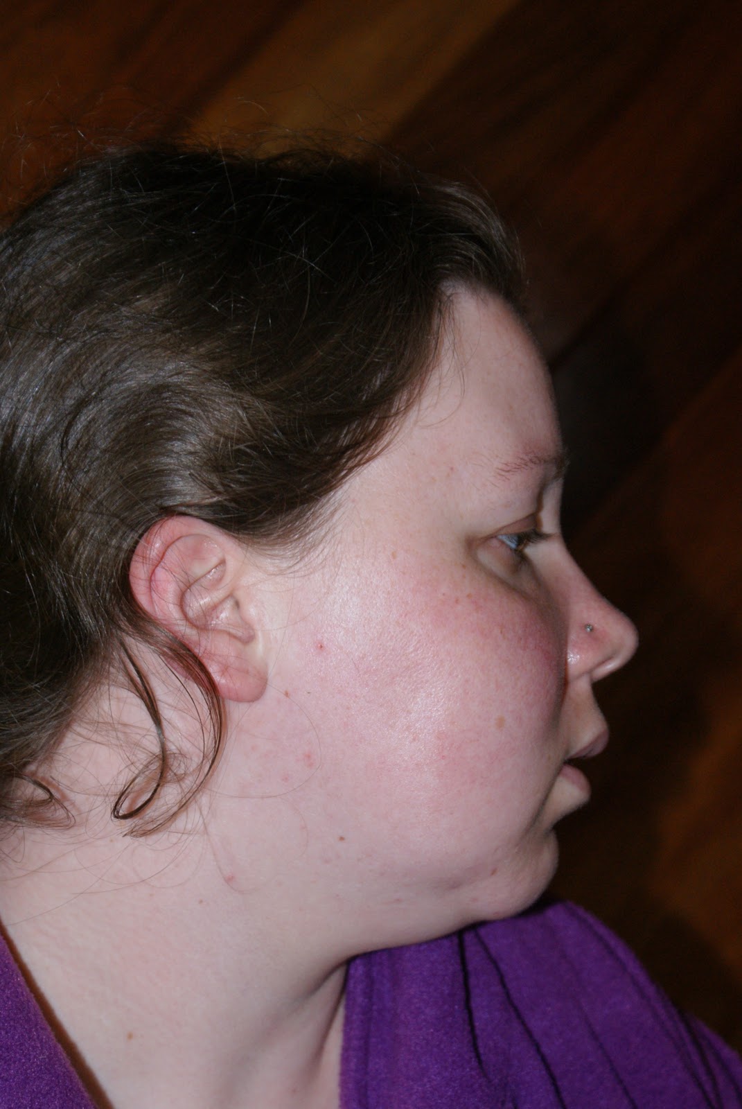 Braces + SARPE/SARME Surgery