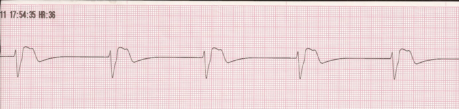 EKG Rhythm Strip Quiz 55: Ventricular Rhythms