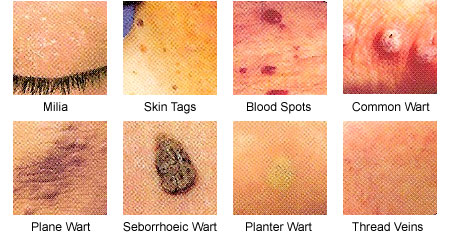 SKIN CONDITION: ABOUT WARTS!