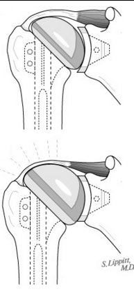 UW Shoulder and Elbow Academy: Lateral humeral offset in shoulder ...