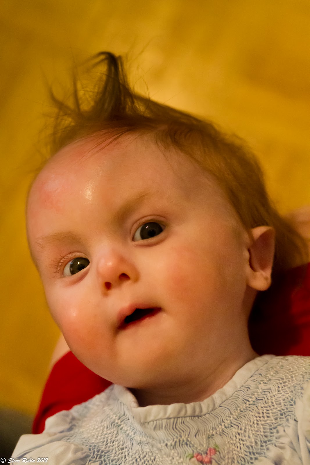 Pray For Lilly: Lilly's Trisomy 18 physical features - Part 2