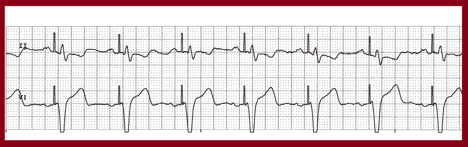 Basic EKG Rhythm Test 20