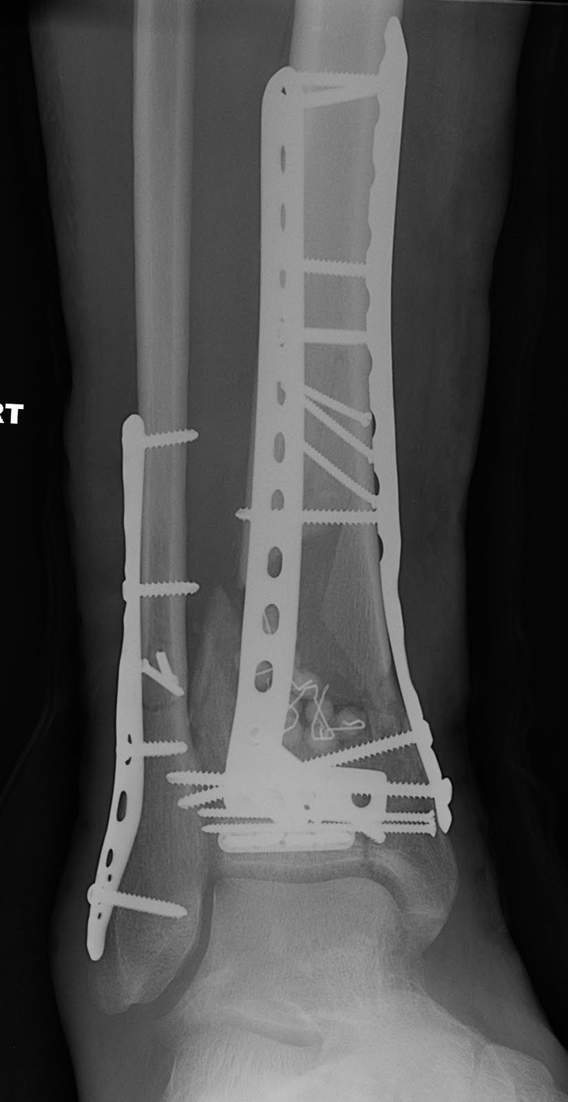 Case of the Month: Fracture cases at Harborview Medical Center ...