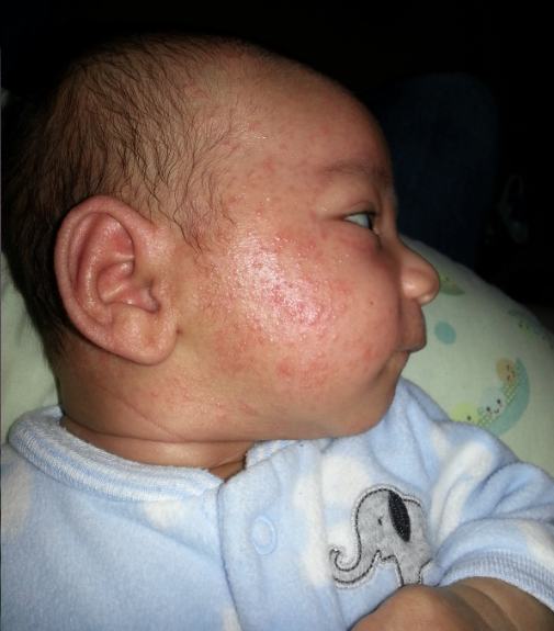 The Lui Family: The Horrible Rash