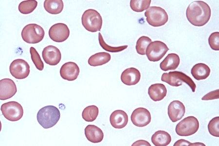 VETERINARY HEMATOLOGY DEXTERVET: sickle cells