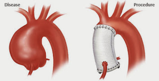 Jim's Bicuspid Heart Valve Diary: Bentall Procedure