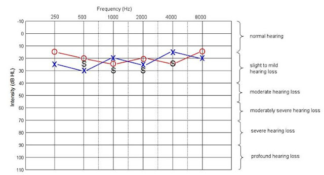 OK chicoesperto: O que é um audiograma? Como ler um audiograma.