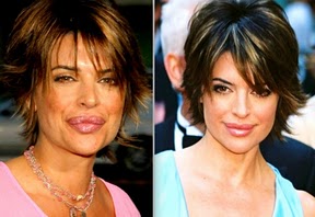 Lisa Rinna Lips Before And After