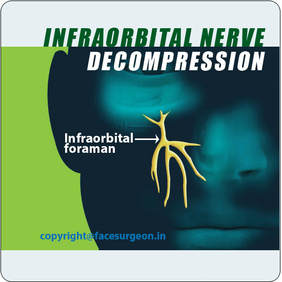 INFRAORBITAL NERVE DECOMPRESSION - Richardson dental and craniofacial ...