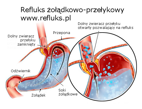 Refluks - czym jest i jakich zasad przestrzegać w chorobie ~ Wasze-Zdrowie