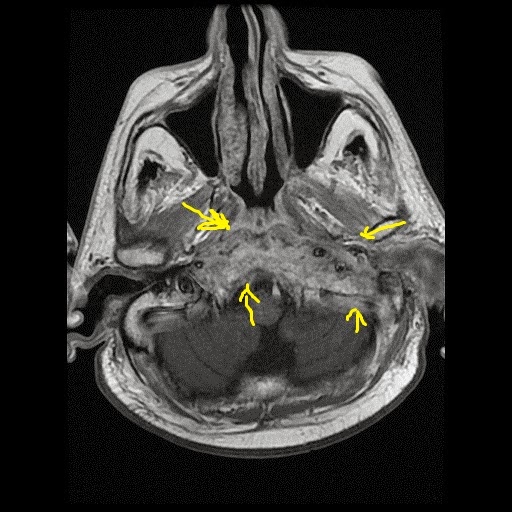 Malignant Otitis Externa-MRI - Sumer's Radiology Blog