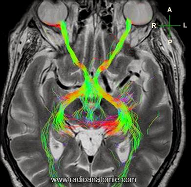 Diarios de Radiologia: TRACTOGRAFÍA: EL CEREBRO AL DESCUBIERTO