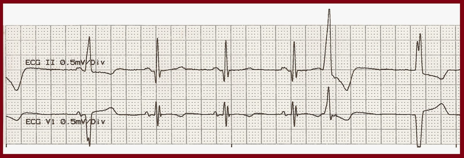 EKG Rhythm Quiz 235