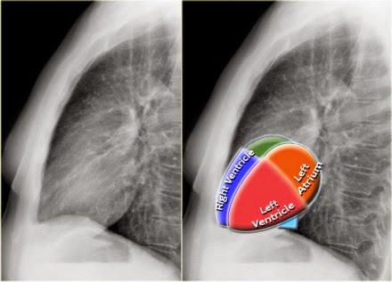 Chest Medicine Made Easy-Dr Deepu: BASICS OF CHEST X RAY-PART 4, THE ...