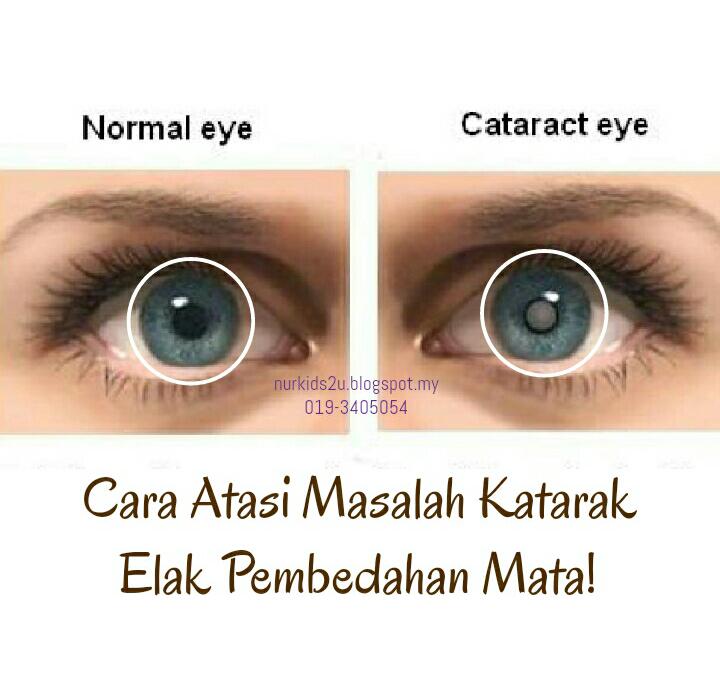 Cara Atasi Masalah Katarak Elak Pembedahan Mata | Never Lose Hope...