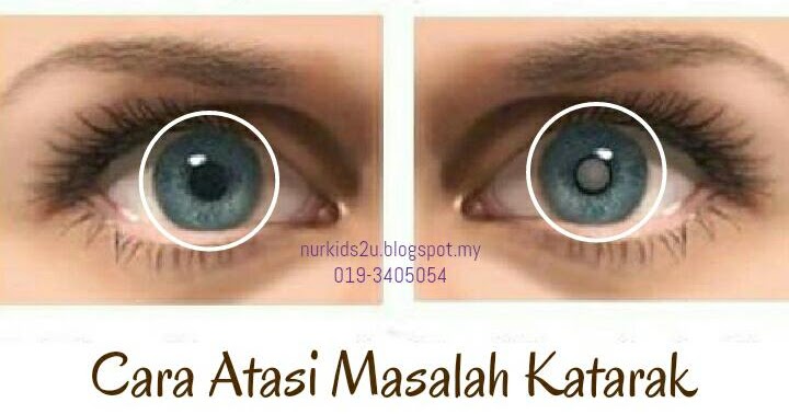 Cara Atasi Masalah Katarak Elak Pembedahan Mata | Never Lose Hope...