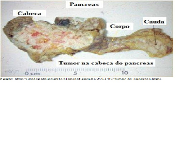 Atlas virtual de histologia e patologia: [CC II: #9] ADENOCARCINOMA DE ...