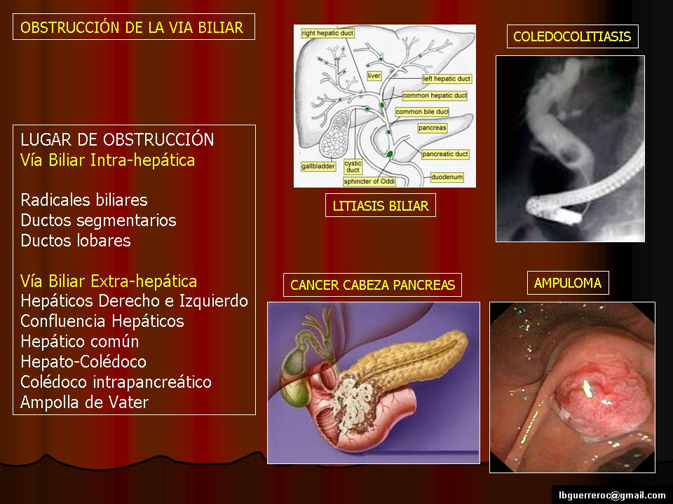 Dr. Luis B. GUERRERO CABRERA: ESTENOSIS de la VIA BILIAR PRINCIPAL