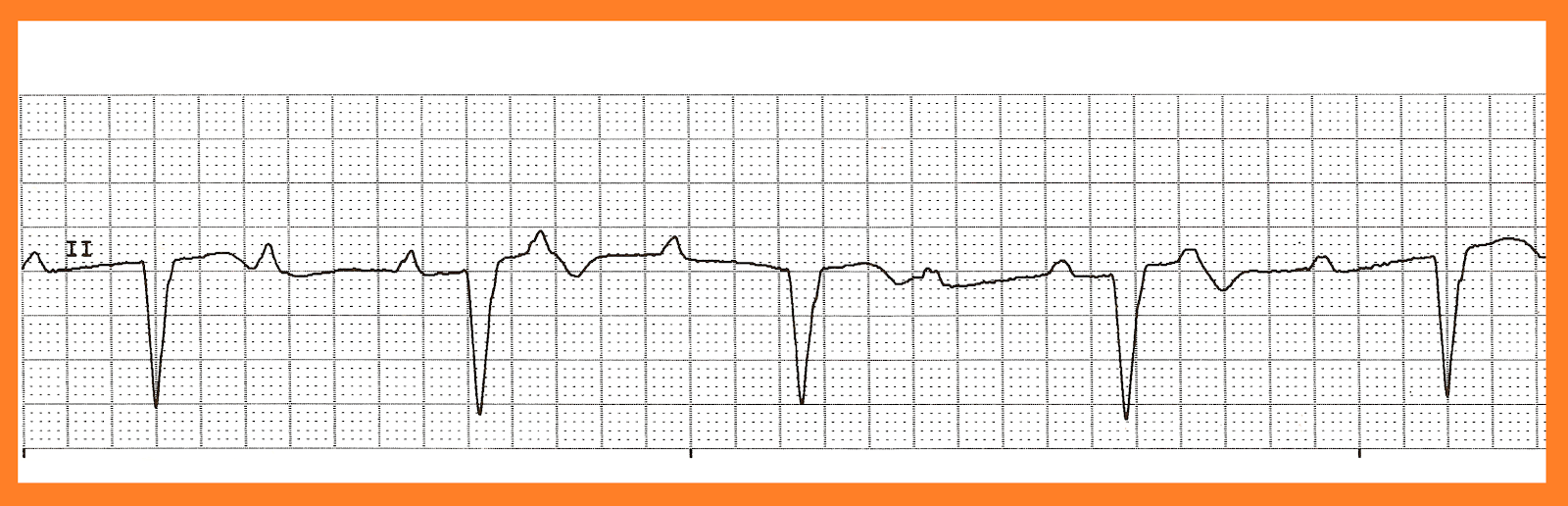 Practice EKG Strips 320