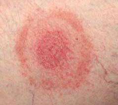 Life With a Hint of Lyme: Ring worm vs. Bullseye rash