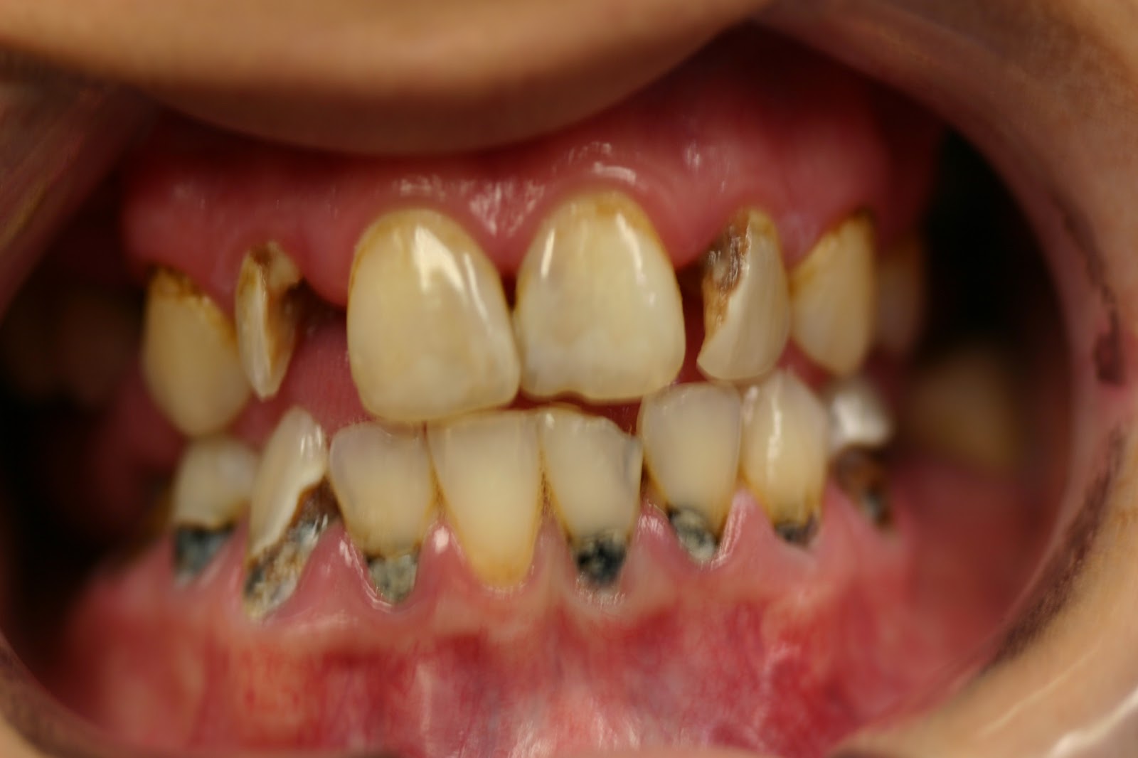 Dr. Robert G. Tupac: Prosthodontics: Dental Disease At A Young Age