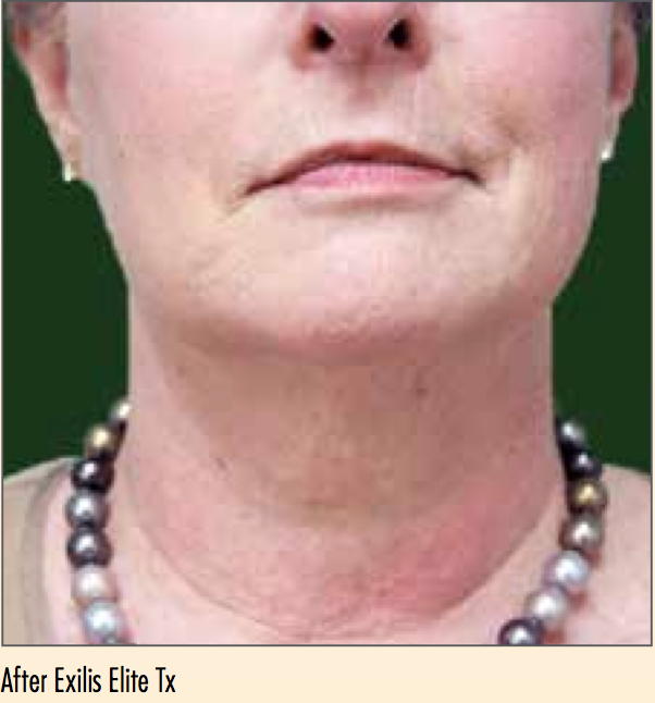 Perfect Body Laser and Aesthetics: Non-Surgical Neck Lift