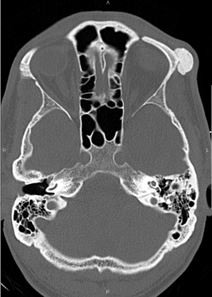El Baúl Radiológico: OSTEOMAS CRANEALES. (Cranial Osteomas. CT Findings ...