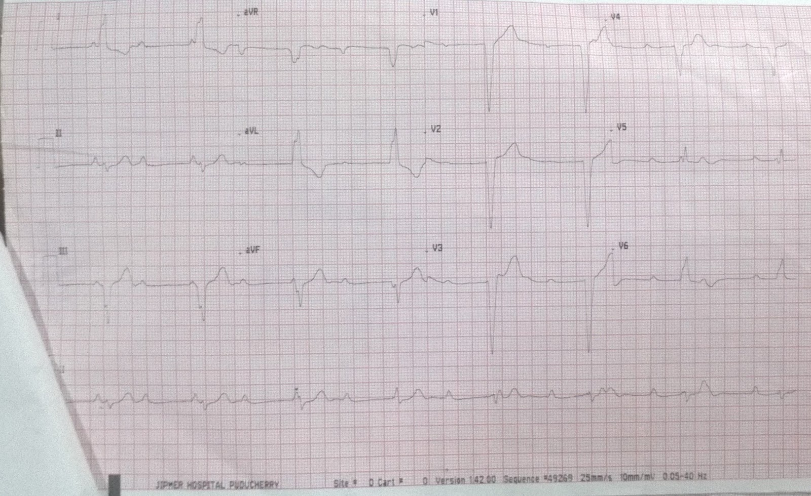 Cardiology window: Complete heart block ecg