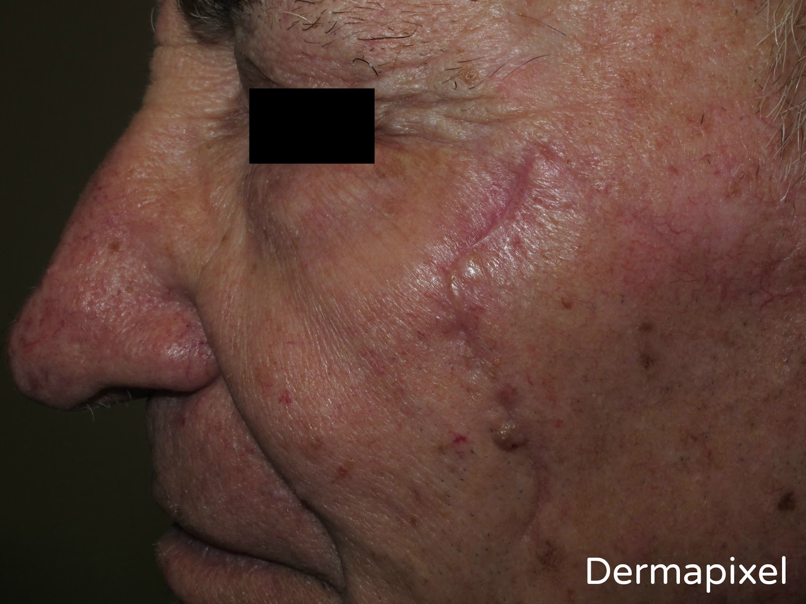 Dermapixel: Léntigo maligno: El melanoma light (pero melanoma al fin y ...