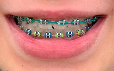 make your own braces: braces picker color lol
