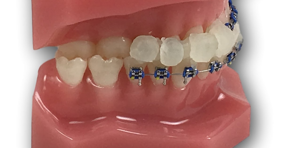 DentaKit.com Products & Tips: Conceal Your Braces with Tooth-Colored ...