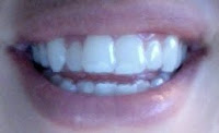 Align With Me - My Invisalign Blog: Invisalign Tray 1 - First Day of Wear