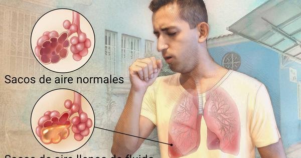 Neumonía (Pulmonía): qué es, síntomas y tratamiento » Pataz.es ...