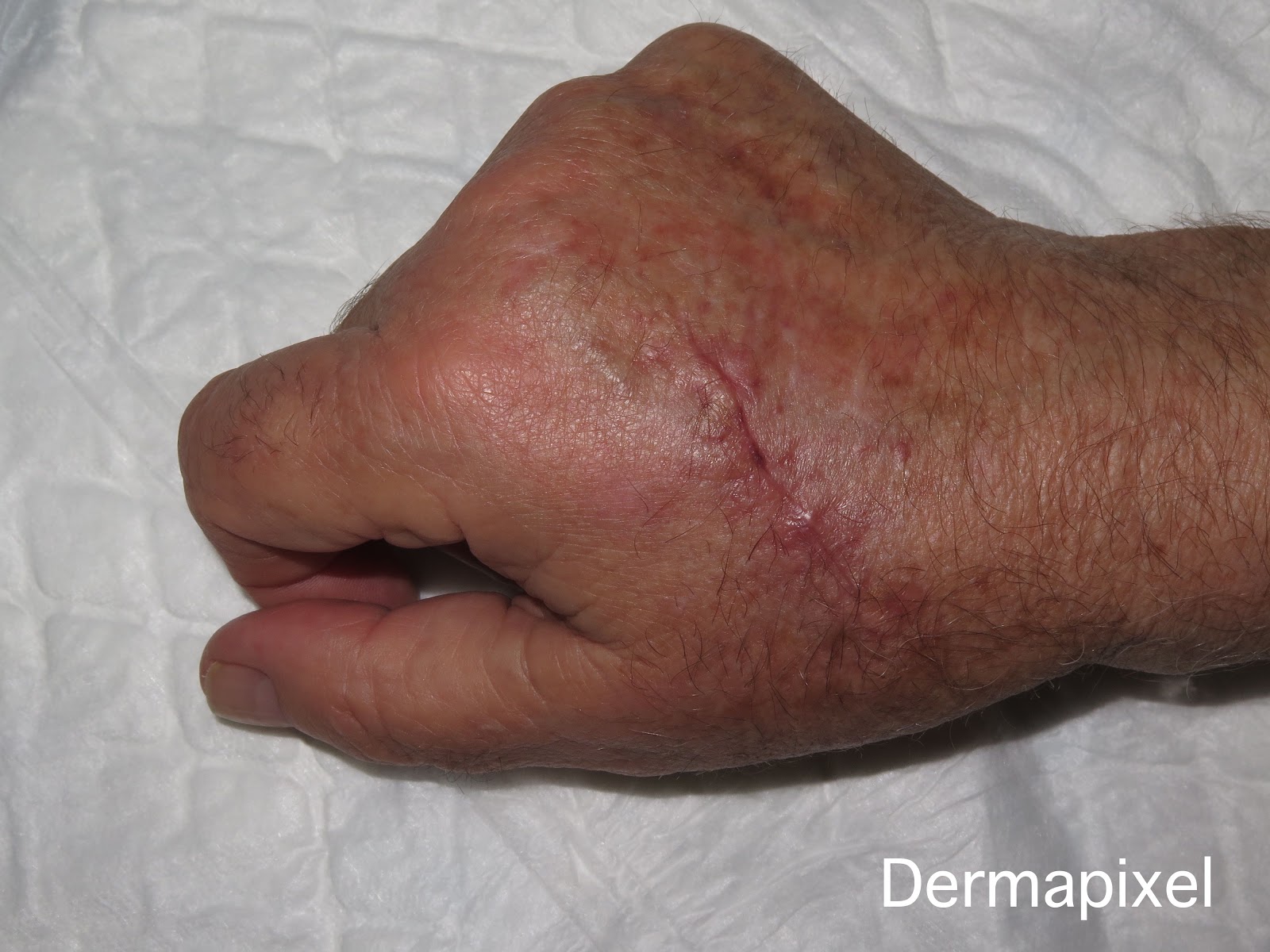 Dermapixel: noviembre 2018