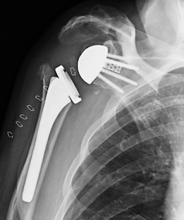 Shoulder and Elbow Surgery: Dislocation of reverse shoulder replacement ...