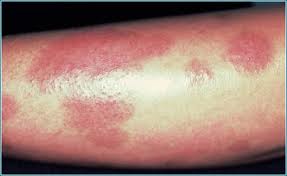 Obat alami dermatitis atau eksim | Rahasia Rumah Herbal