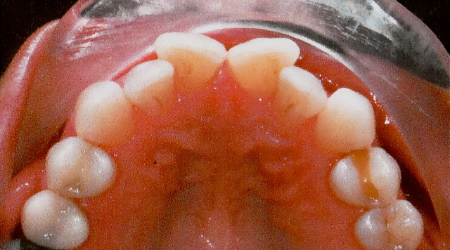 ArtCee: Invisalign me!